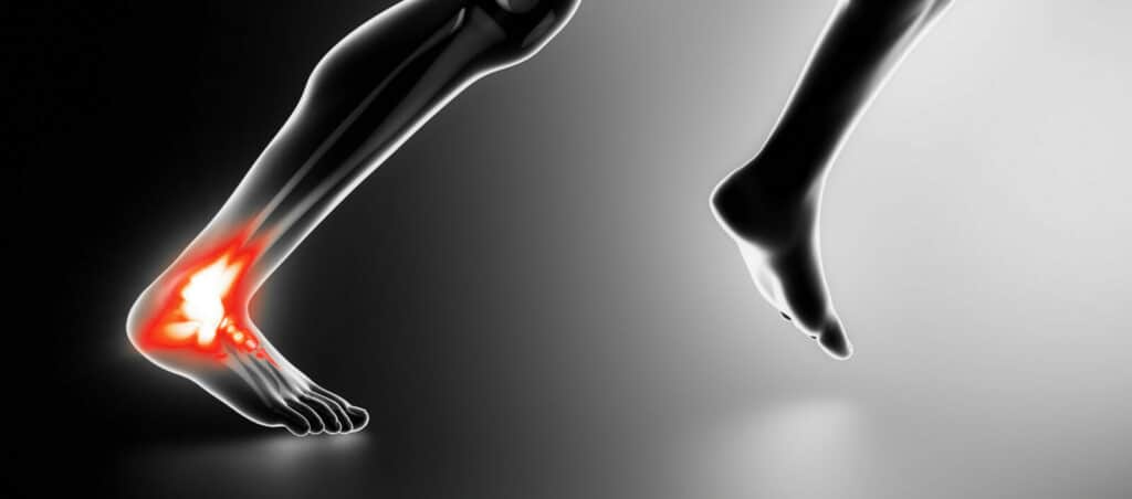 Douleur au talon à Paris - Les généralités | Dr Paillard