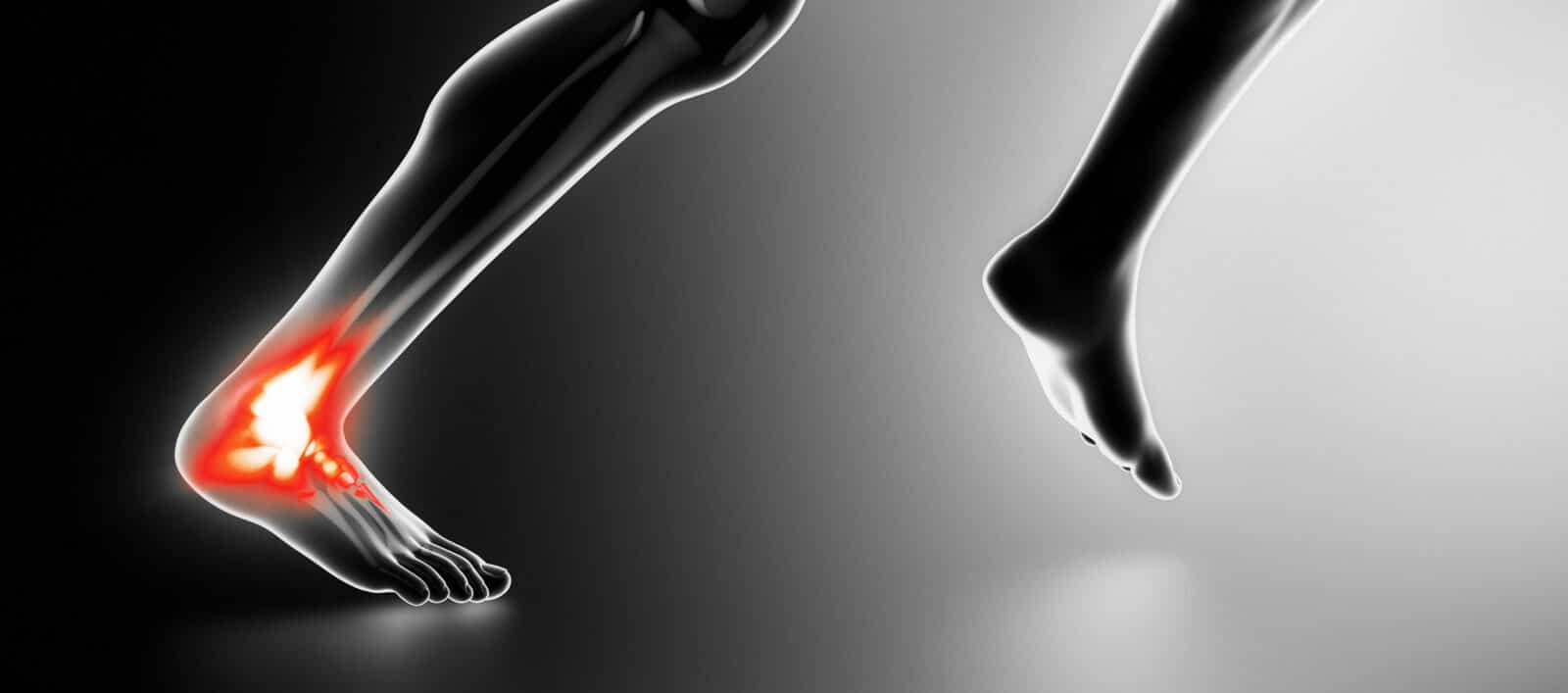 Douleur au talon à Paris - Les généralités | Dr Paillard