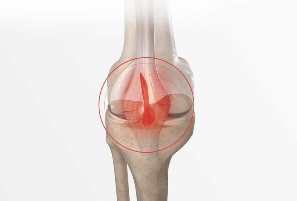 Arthrolyse du genou à Paris - Chirurgie orthopédique | Dr Paillard