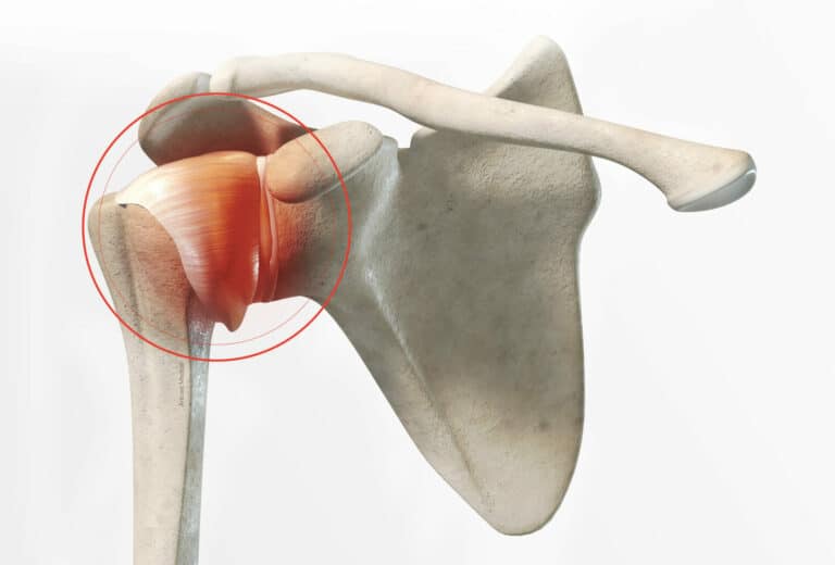 Définition, symptômes et diagnostic de la capsulite de épaule | Dr Paillard