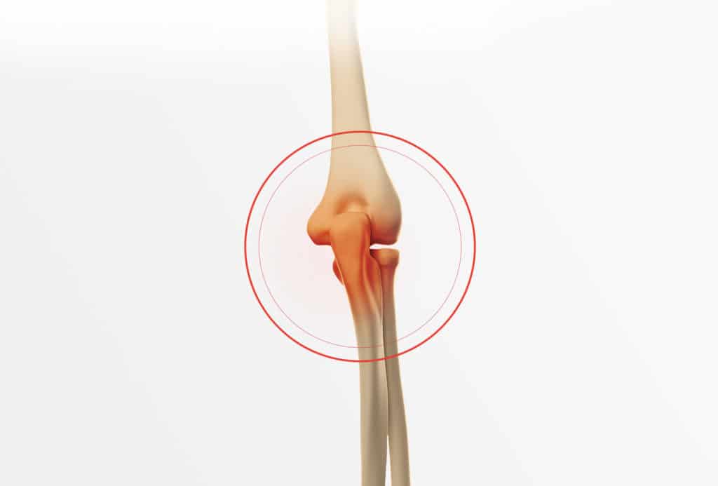 Définition, symptômes et diagnostic de la fracture du coude | Dr Paillard