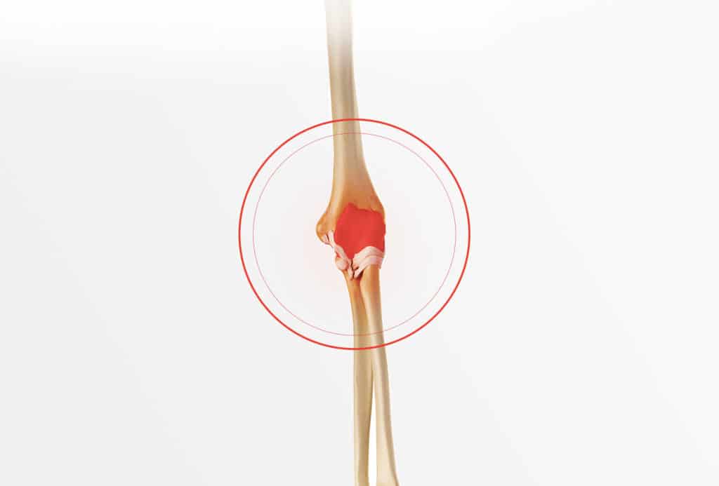 Définition, symptômes et diagnostic de la raideur du coude | Dr Paillard
